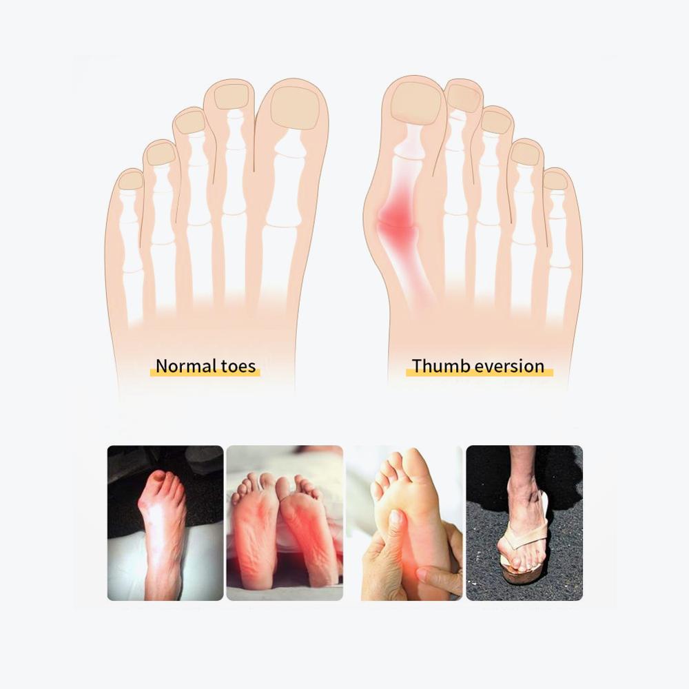 Soft Bunion Corrector with Gel Splint & Cushioned Pad Separator ...